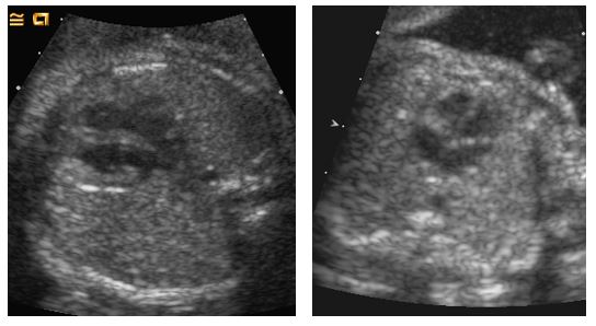 Heart – [Step 4] Cardiac Axis and Chest Masses – myminifellowship