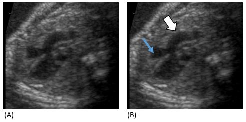 Great Vessels – Left Ventricular Outflow Tract – myminifellowship