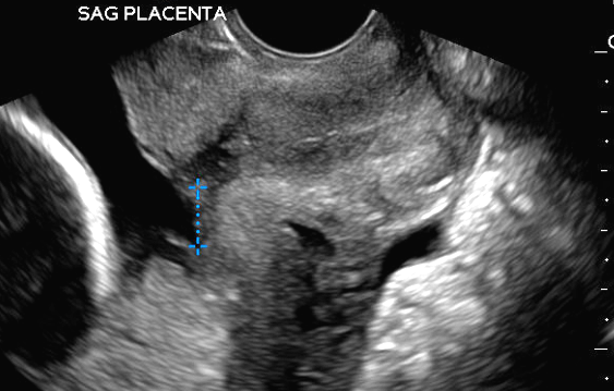 Evaluating the Placenta: Clarifying the confusing world of previa ...