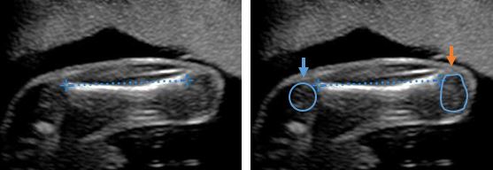 Femur Length – myminifellowship