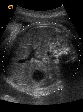 Abdominal Circumference – myminifellowship