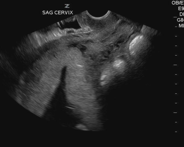 Evaluating the Placenta: Clarifying the confusing world of previa ...